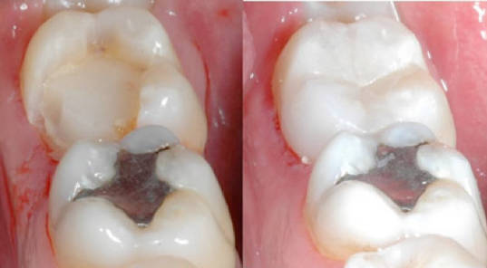 Odontoiatria conservativa, endodonzia ed intarsi - Dental Smile Clinic